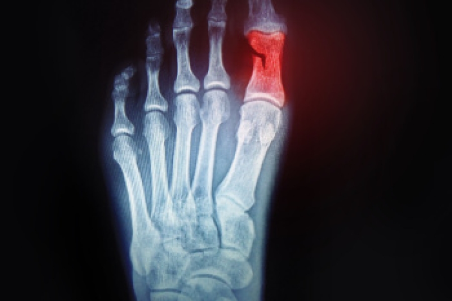 Symptoms and Appearance of a Broken Toe